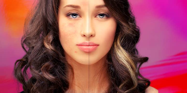 How To Get Rid Of Acne Scars 10 Treatments And Remedies Yourtango