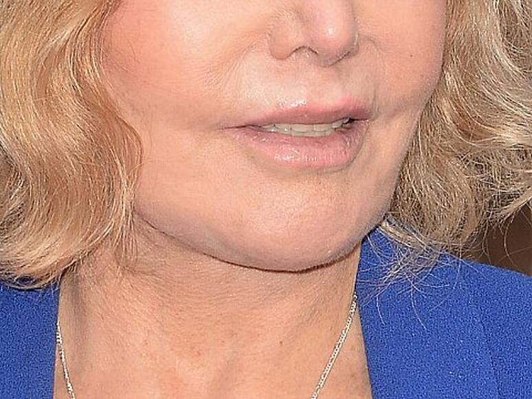 Oscars 2014 John Travoltas And Kim Novaks Bad Plastic Surgery Yourtango