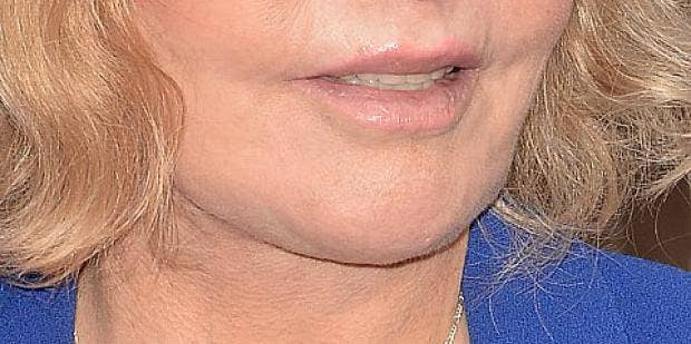 Oscars 2014 John Travoltas And Kim Novaks Bad Plastic Surgery Yourtango